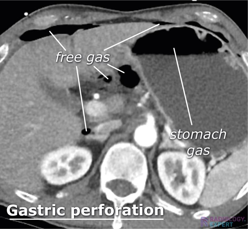 CT abdomen general